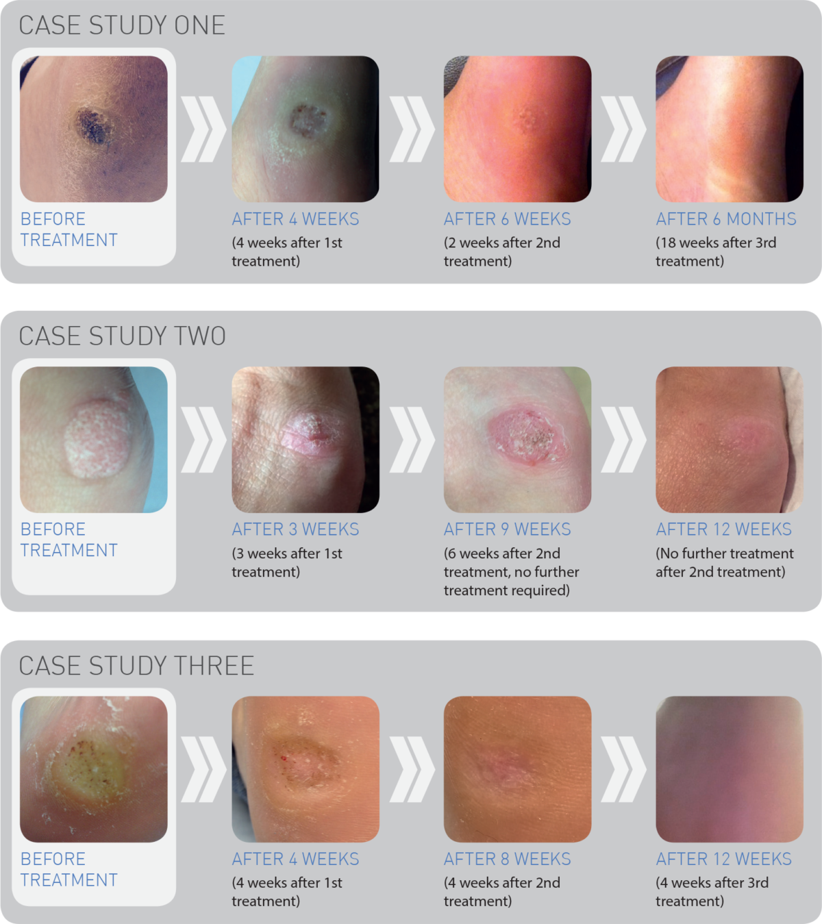 Swift Verruca Treatment in Merseyside | Step First Podiatry