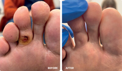 Curacorn Injections in St Helens | Botox for Foot Pain Relief | Step First